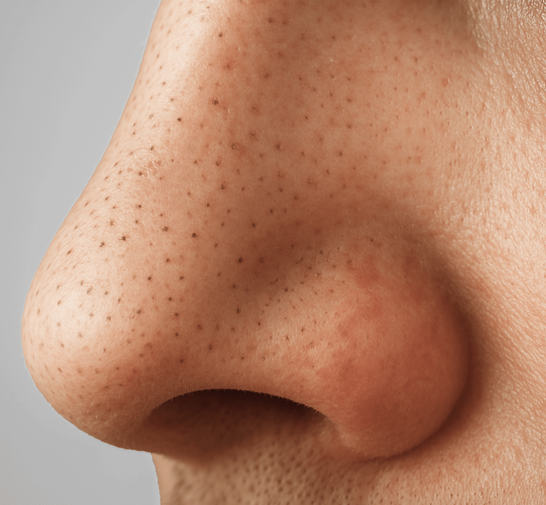 The Blackhead Lifecycle: How They Form, Live, and (Finally) Die – Vue US